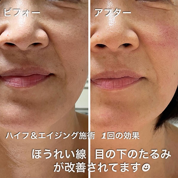 ハンドエステ+ハイフ(HIFU) ビフォー・アフター｜ルマエクレは医療機関でも導入されている本格ハイフ(HIFU)を導入。
